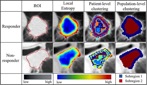Ct Based Subregional Radiomics Using Hand Crafted And Deep Learning Features For Prediction Of