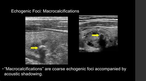 Thyroid Imaging Reporting Data System PPT