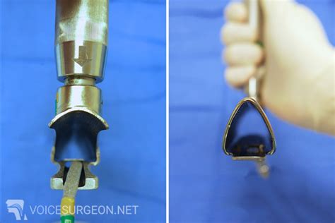 Microlaryngoscopy Microlaryngoscopy With Biopsy Voice Surgeon