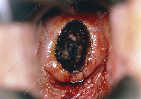 Cone Biopsy Definition At Susan Jaimes Blog