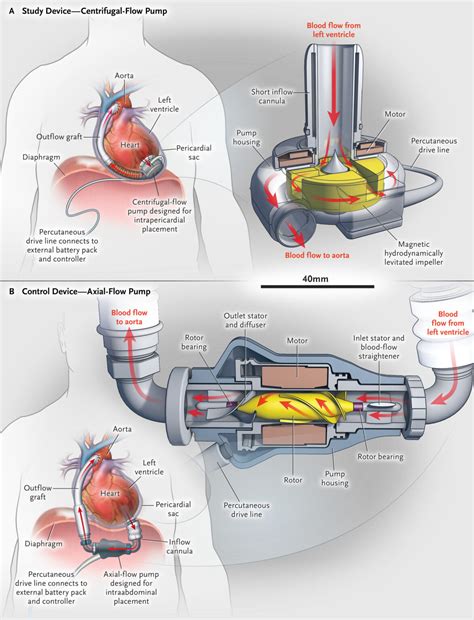 Cfd Optimization Of A Left Ventricular Assist Device Lvad › Caeses