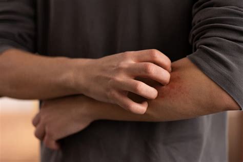 Expert Guide Atopic Dermatitis Symptoms And Treatments