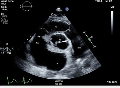 Transthoracic Echo Parasternal Short Axis At The Aortic