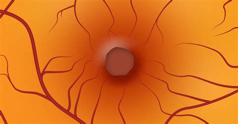 Operculated Retinal Hole