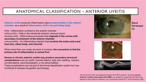 Slide Uveitis Anterior To Posterior Pptx Eye And Vision Conditions