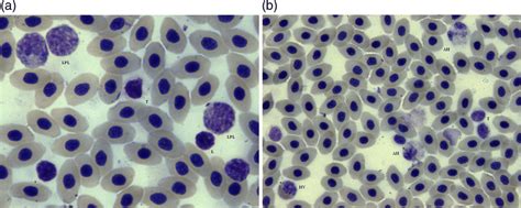 A Three Plasmacytes Large Plasmacytoid Lymphocytes Lpl ∼75μm A