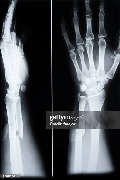 Broken Metacarpal X Ray Broken Metacarpal X Ray