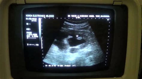 Pyonephrosis Rt Youtube