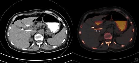 A Left Axial Slice Of A Dual Energy CT Abdomen Pelvis Without IV Download Scientific