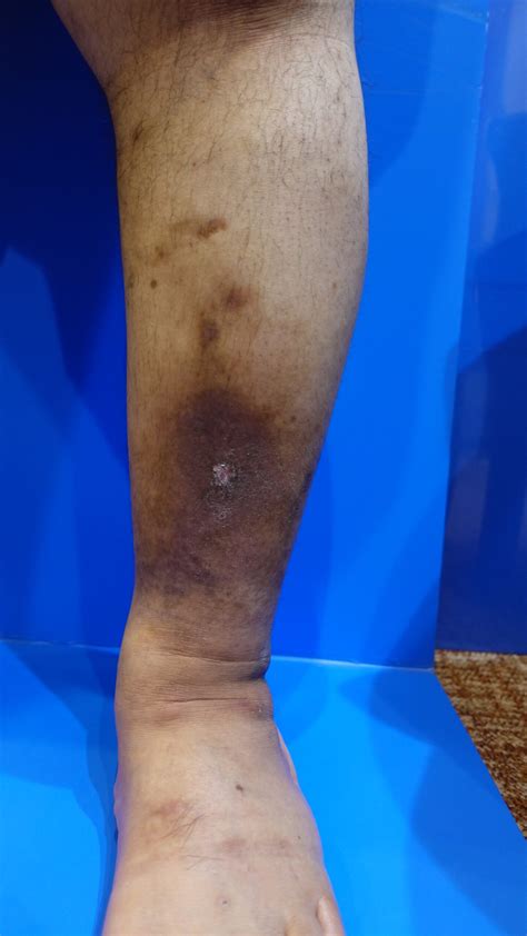 Dermatitis Caused By Untreated Varicose Veins And Its Countermeasures