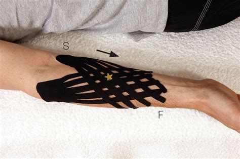 Use Taping To Control Forearm Swelling Human Kinetics Canada
