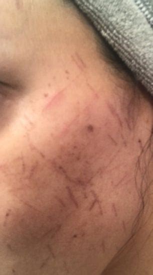 Scratch Marks On Skin