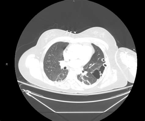 Spontaneous Pneumothorax Bleb