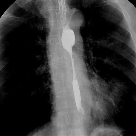 Original Intrapapillary Capillary Loop Ipcl Pattern Classification Download Scientific