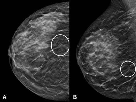 Case Architectural Distortion Radiology Ucla Health