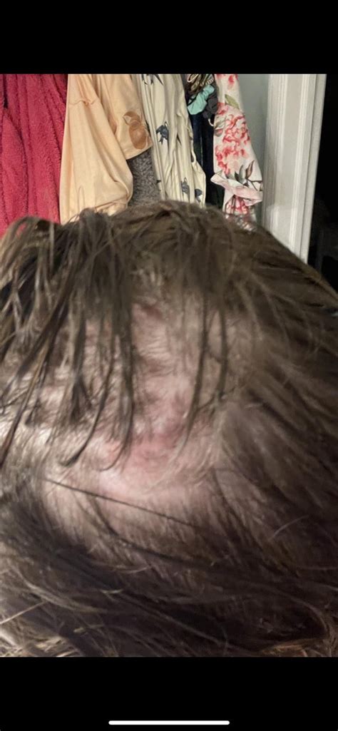 Doctor Prescribed Gabapentin For Only 10 Days For Fresh Shingles