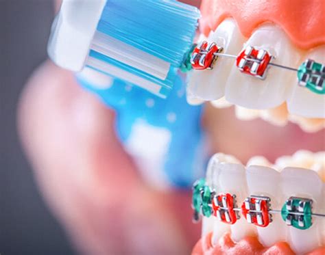 Traditional Braces Morgan Hill Crooked Teeth Timeless Smiles Morgan