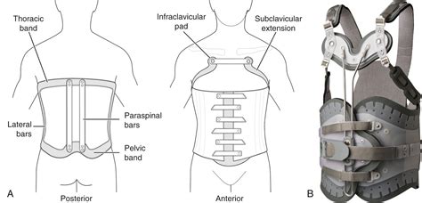 Principles And Components Of Spinal Orthoses Clinical Tree