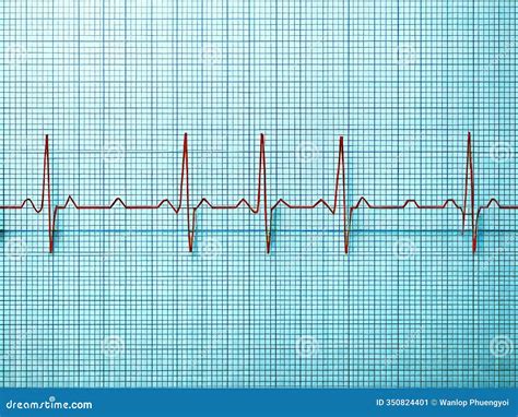 Pacemaker Rhythm Strips