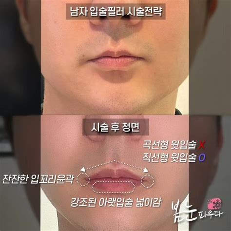 봄눈피우다의원 남자 입술필러 시술 전략💋 ⠀ 📌긴 일자형 입술 인중디자인과 곡선형의 입술라인은