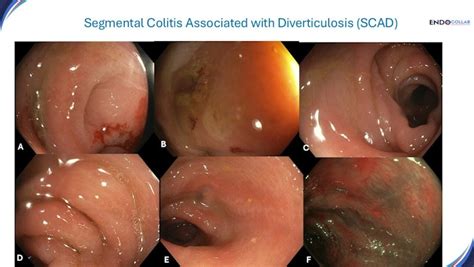 Segmental Colitis Associated Diverticulosis Scad