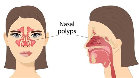 What Causes Polyps In The Nose