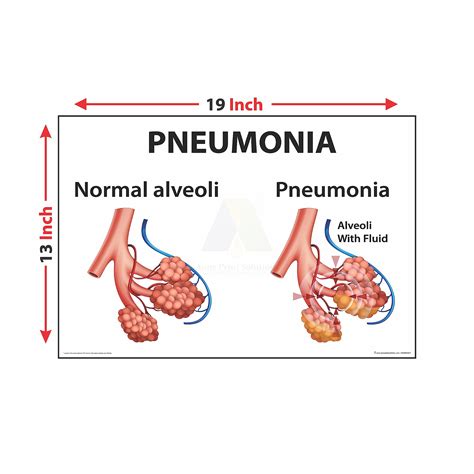 Pneumonia Diagram The Effects Of Pneumonia On The Body