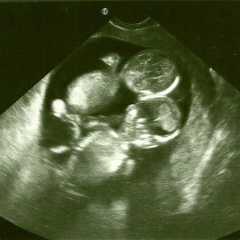 Twins With The Same Egg But Different Sex The Nd Genotype In The World Baby And Mom Story