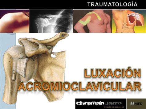 Luxacin Acromio Clavicular Anatomia Humana Musculos Lesiones En El