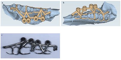 Planification Of The 3d Printed Surgical Metal Guide Eight Virtual Download Scientific Diagram