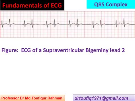 Approach To A Patient With Qrs Complex Abnormality In Ecg Ppt