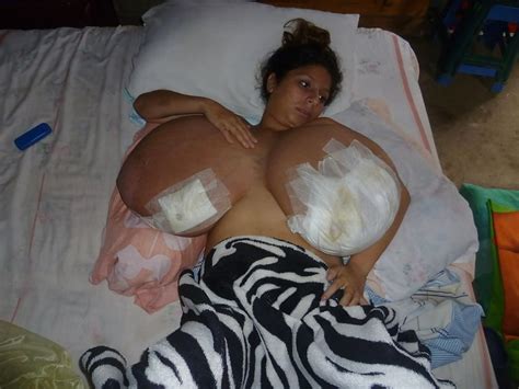 Massive Tits Breast Reduction Porn Pictures Xxx Photos Sex Images 3908244 Pictoa