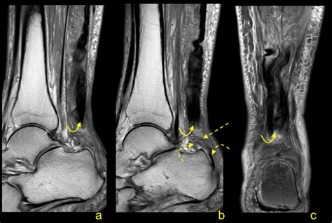 Total Achilles Tendon Rupture In The Distal Part 1 Week Ago Dashed