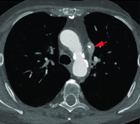 Persistent Left Superior Vena Cava Svc With Absent Right Svc The