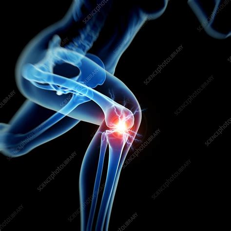Human Knee Pain Illustration Stock Image F0111005 Science Photo
