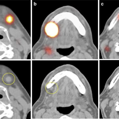 Importance Of Spect Ct And Low Dose Ld Ct In Characterising Sentinel Download Scientific