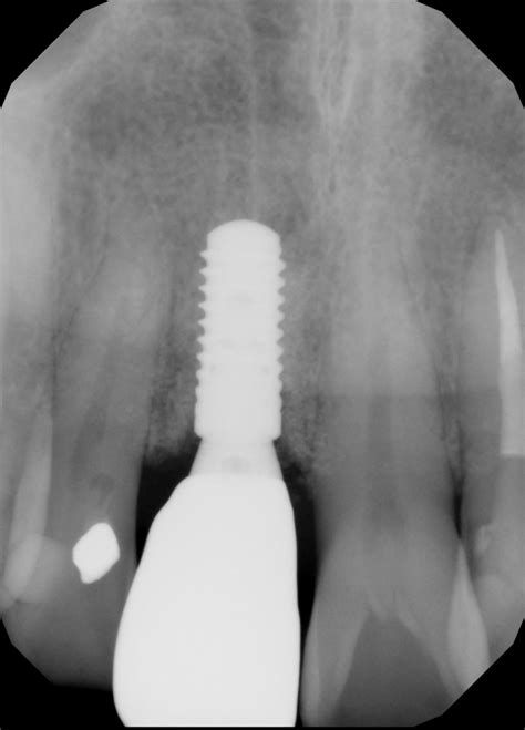 Soft Tissue Augmentation Before Implant Placement Iti Blog