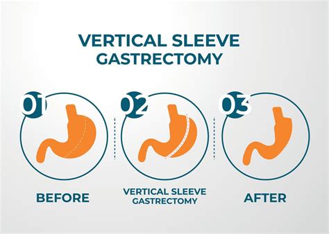 Laparoscopic Sleeve Gastrectomy Vertical Gastrectomy Weight Loss