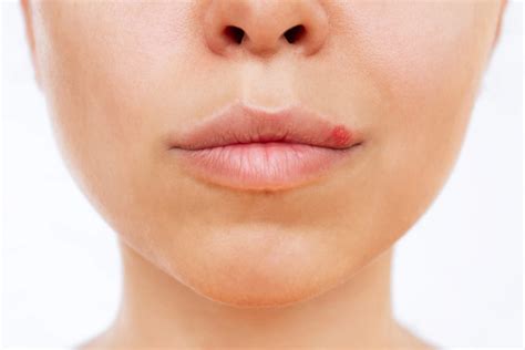 L Lysine And Cold Sores Hsv 12 How Its Used