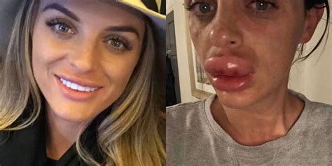 This Womans Botched Fillers Made Her Lips Swell 5x Their Normal Size