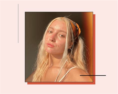 12 Ways Get Rid Of A Stubborn Pimple According To Dermatologists