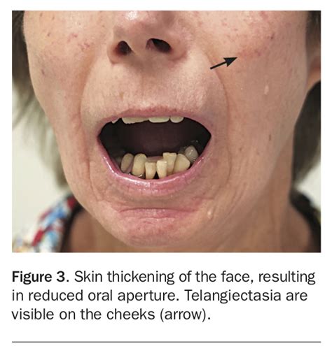 Systemic Scleroderma Face