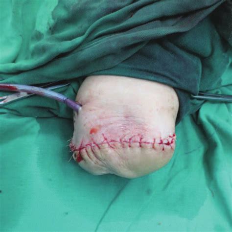 Forearm Amputation Download Scientific Diagram