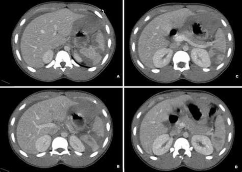 Admission Ct Abdomenpelvis With Iv Contrast Demonstrating Grade Iiiiv Download Scientific