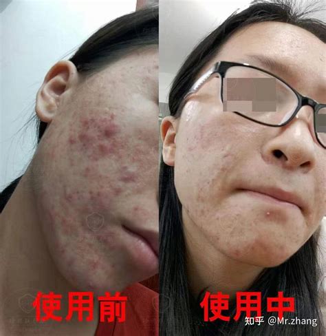 有什么方法可以完全祛痘（一点痘痘不剩的那种）？ 知乎