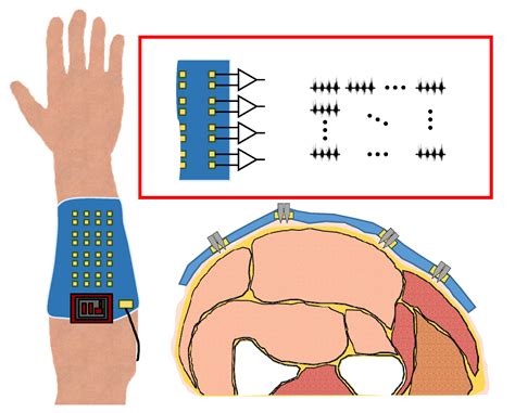 Wireless Semg System With A Microneedle Based High Density Electrode Array On A Flexible Substrate