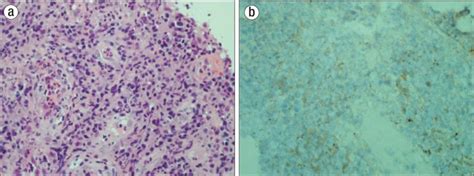 Syphilitic Proctitis Pmc