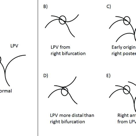 Caudate Right Lobe Ratio In Case Of Portal Venous Variants In Normal