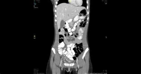 Ct Scan Showing Perforated Appendix With Extraluminal Contrast In The Download Scientific