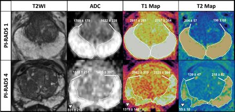 Artificial Intelligence Magnetic Resonance Fingerprinting Technology For Noninvasive